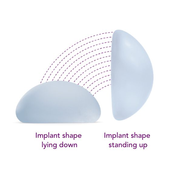 Motiva Breast Implants | Delaware Valley Plastic Surgery | Cherry Hill